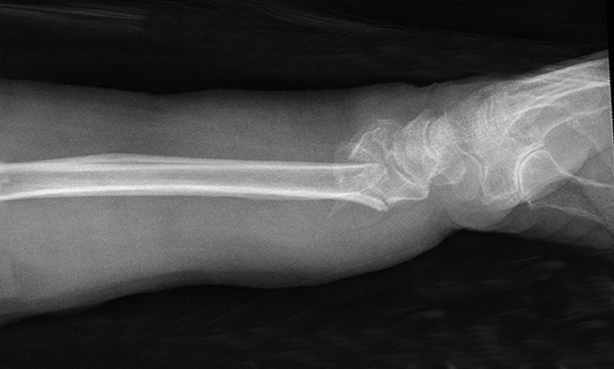 COLLES' FRACTURE | Hand Surgery Primer for Students of the Hand